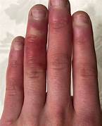 Chilblains – Causes, Symptoms, and Effective Treatment – Lifestyle for ...