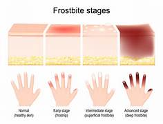 Chilblains – Causes, Symptoms, and Effective Treatment – Lifestyle for ...